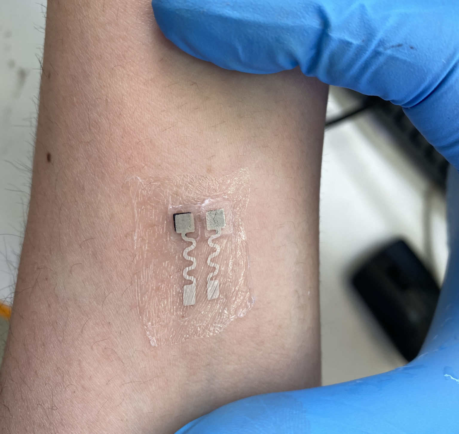 Israeli TB patch could save millions - SA Jewish Report