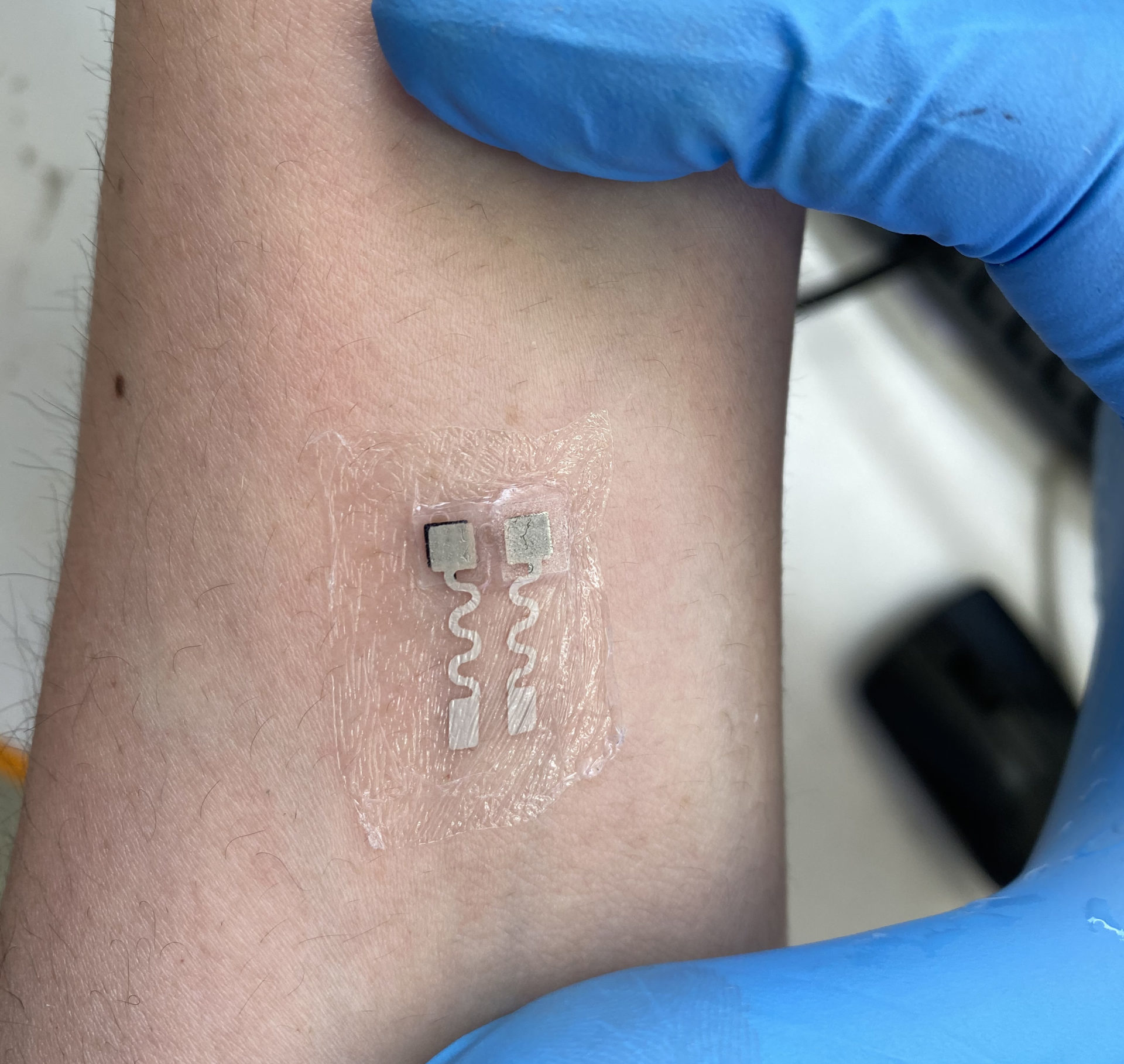 Israeli TB patch could save millions - SA Jewish Report